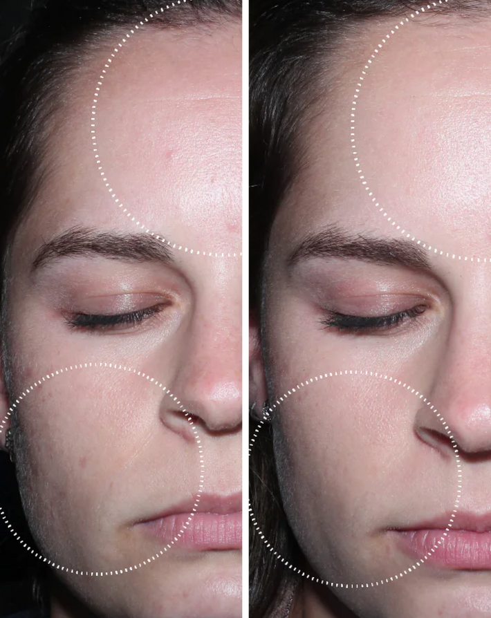 How it Works & Benefits of Microinfusion | Droplette