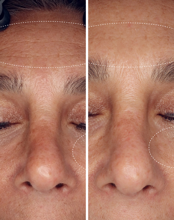 How it Works & Benefits of Microinfusion | Droplette