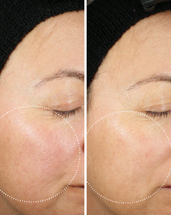 How it Works & Benefits of Microinfusion | Droplette